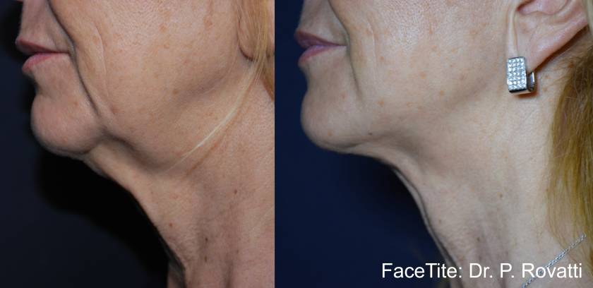 FaceTite or Non-Surgical Facelift | Clinica Kam